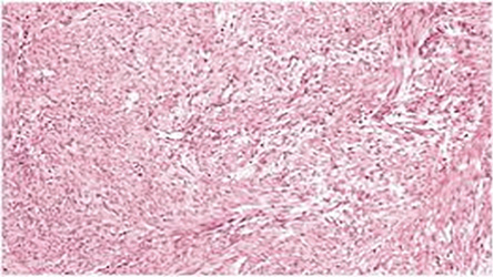 Figure 4: Histopathology: diffuse benign leiomyomatosis with signs of ...