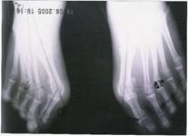 Full Text: Scarf osteotomy - Is it the procedure of choice in hallux ...