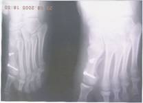 Full Text: Scarf osteotomy - Is it the procedure of choice in hallux ...