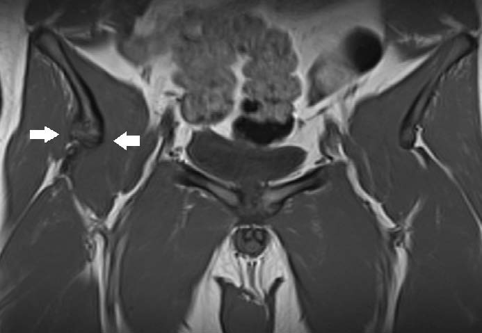 Anterior Inferior Iliac Spine Avulsion
