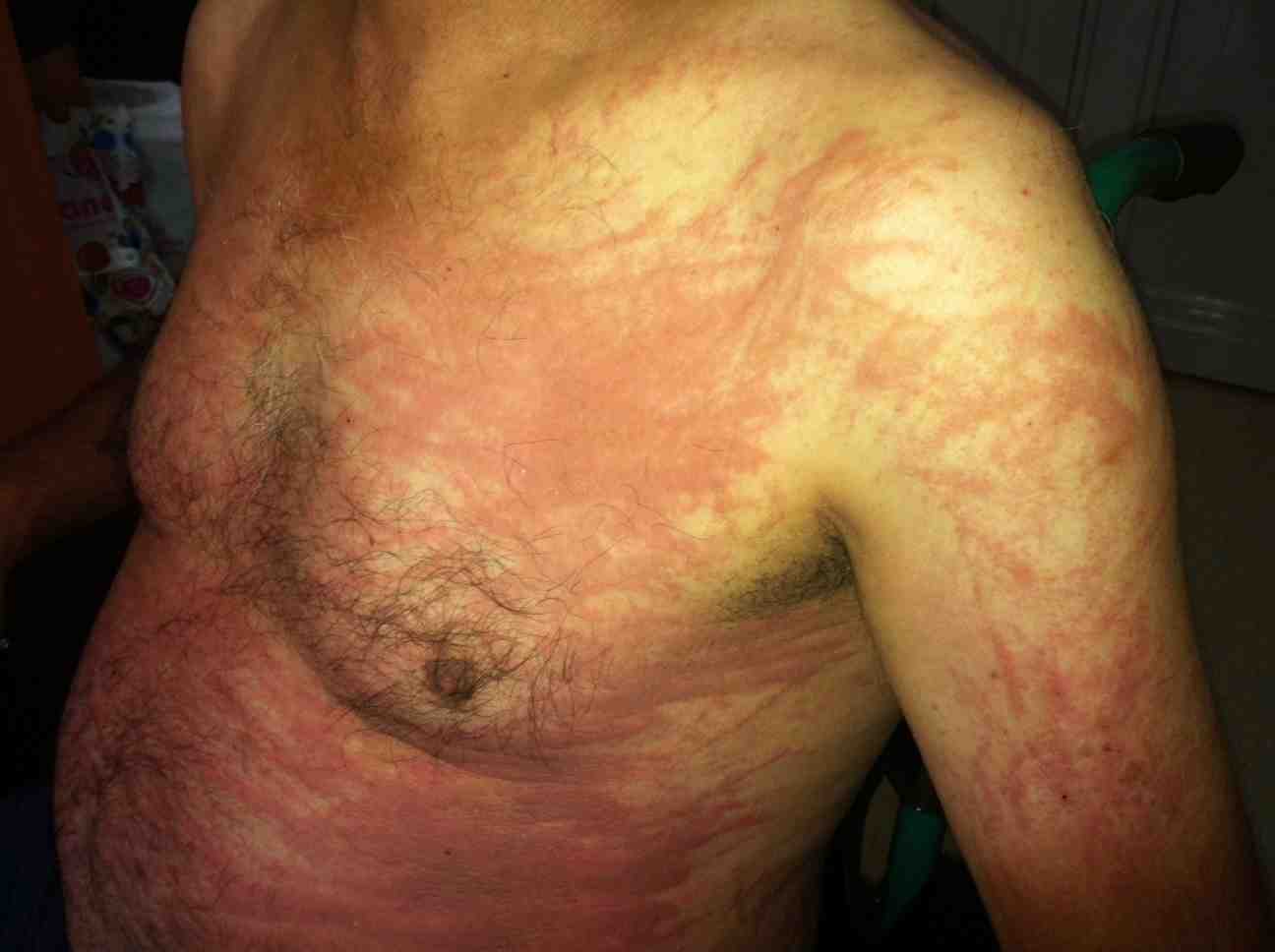 Still Disease Skin Rash at Sherlyn Weyer blog