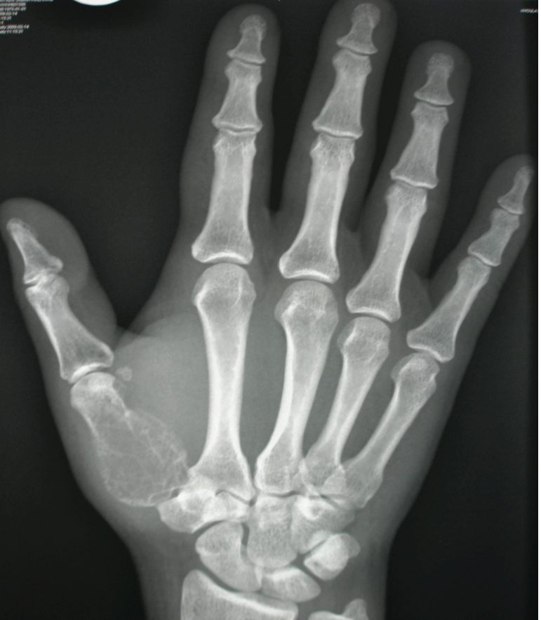 Primary Bone Tumors Pdf - minemanager