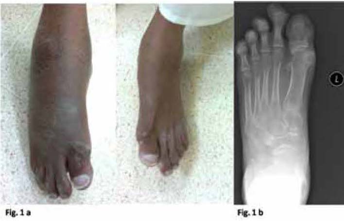 Fibrodysplasia Ossificans Progressiva Toes